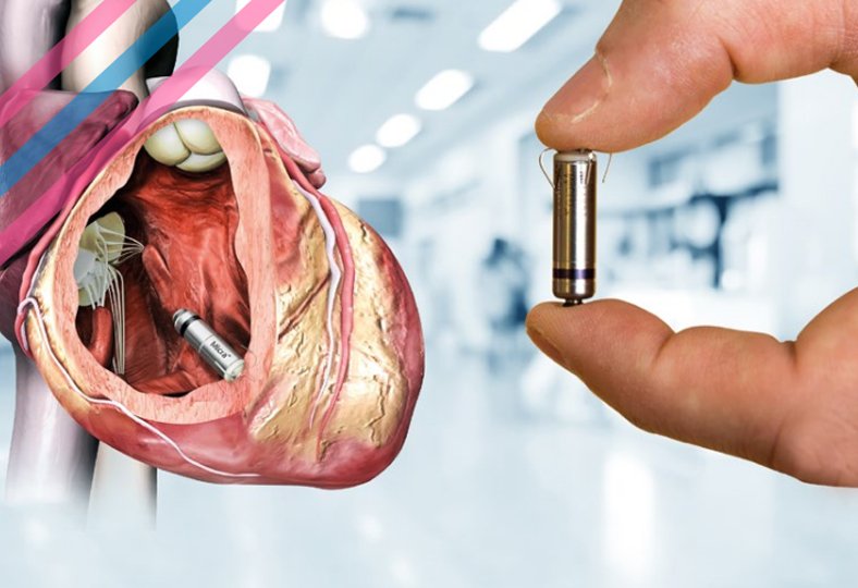First Single Chamber Micra Leadless Pacemaker In Kerala First Dual First Single Chamber Micra Leadless Pacemaker In Kerala First Dual
